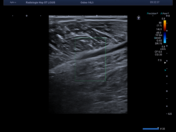 Quand une lésion en cache une autre...