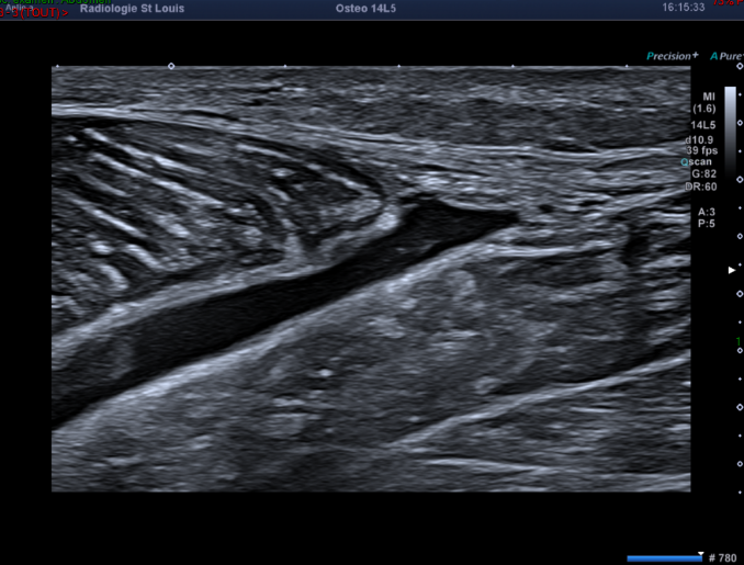 Quand une lésion en cache une autre...